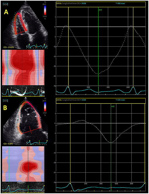 Frontiers | The Predictive Value of Right Ventricular Longitudinal ...