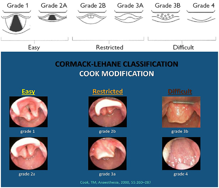 Frontiers | Management of the Unexpected Difficult Airway in Neonatal ...