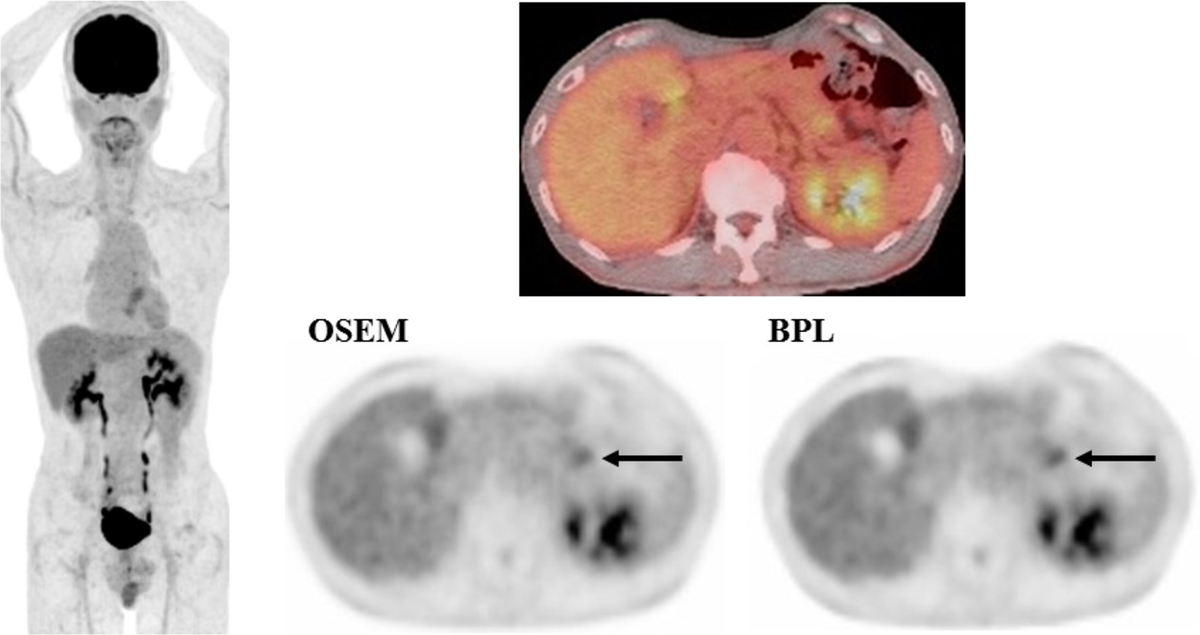Frontiers | Effects of New Bayesian Penalized Likelihood Reconstruction Algorithm on ...