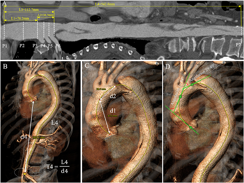 Frontiers | Aortic Geometric Alteration Associated With Acute Type B ...