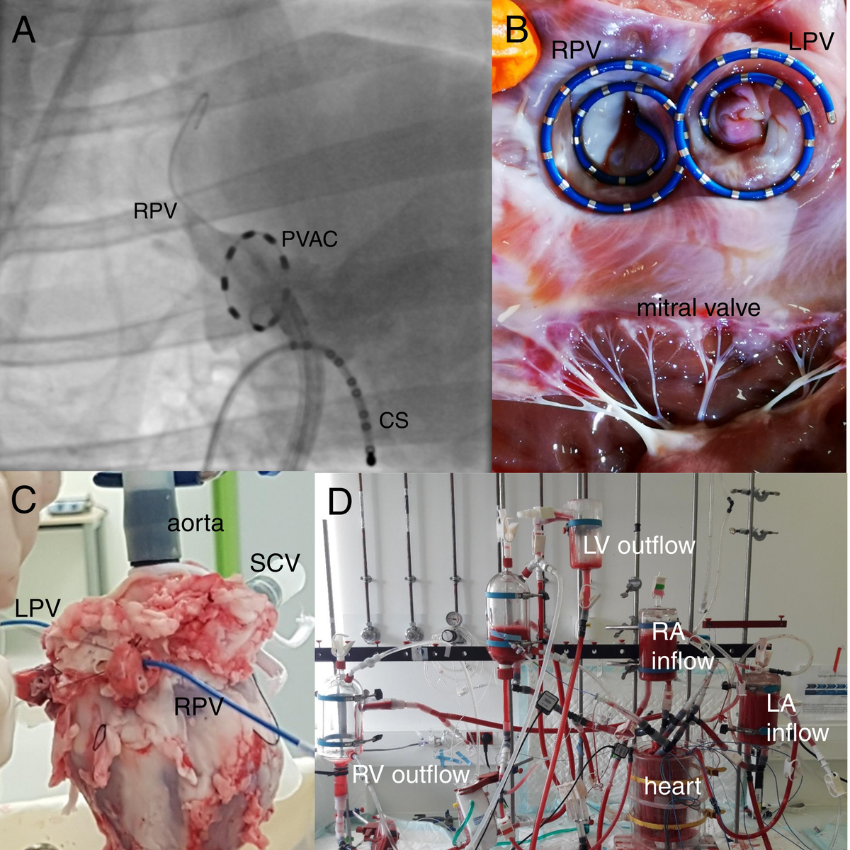 Frontiers | Localized Pulmonary Vein Scar Promotes Atrial Fibrillation ...