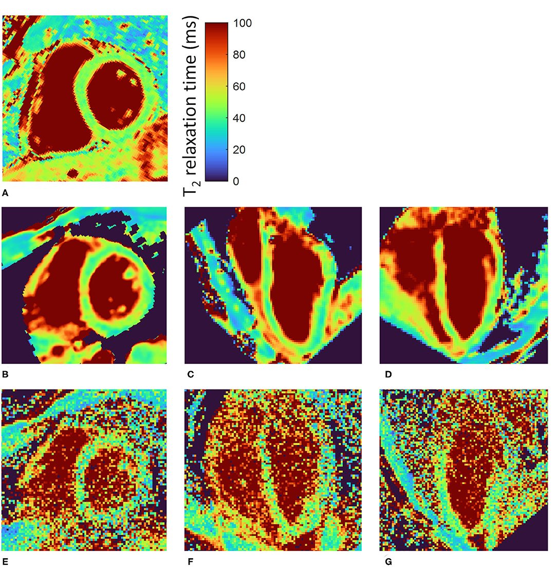 Frontiers | Respiratory Motion-Registered Isotropic Whole-Heart T2 ...