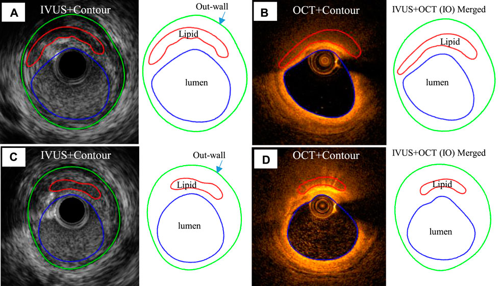 Frontiers | Using Optical Coherence Tomography and Intravascular ...