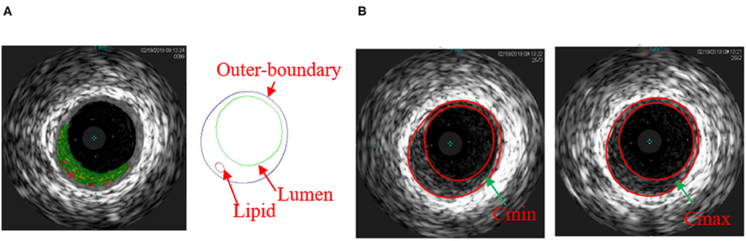 Frontiers | Quantifying Patient-Specific in vivo Coronary Plaque ...