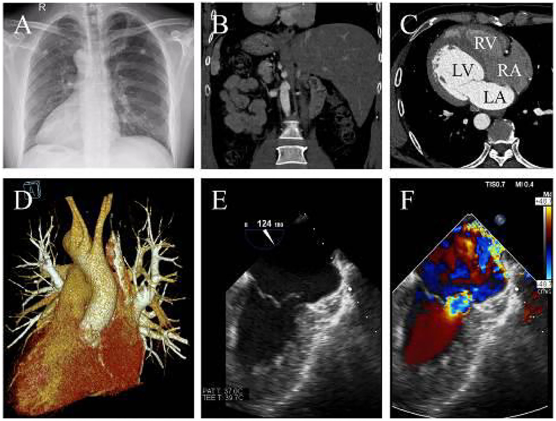 Frontiers | Case Report: The Cox-Maze IV Procedure in the Mirror: The ...