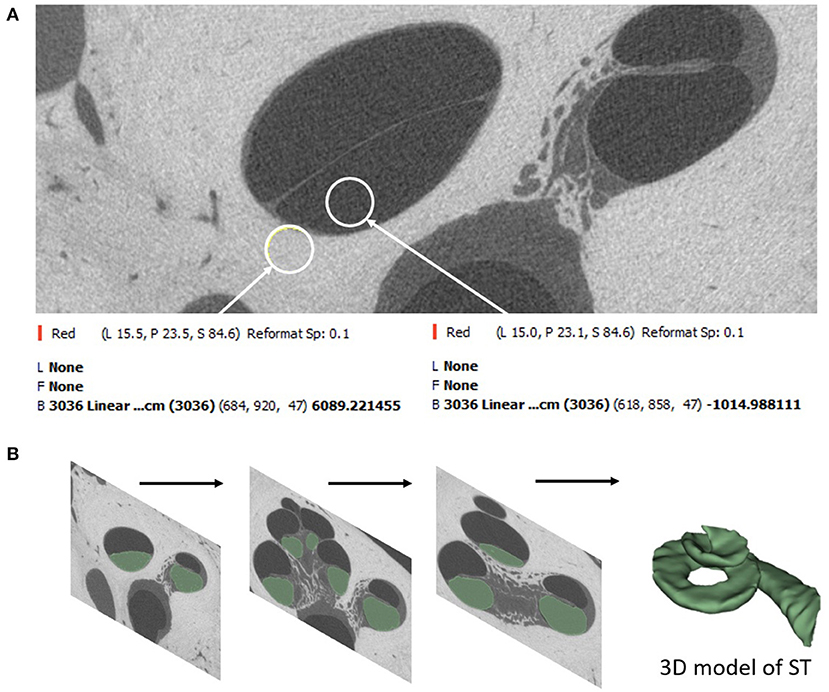 Frontiers | Cochlear Size Assessment Predicts Scala Tympani Volume and ...