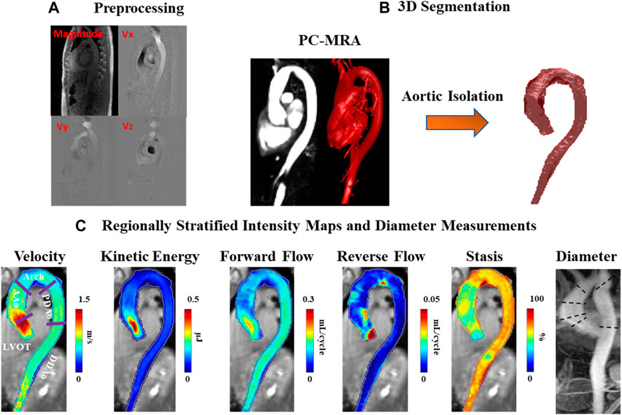 Frontiers | Hemodynamic Assessment in Bicuspid Aortic Valve Disease and ...