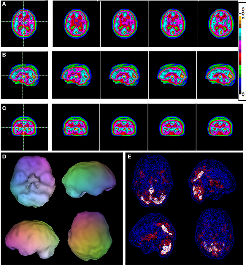 Adhd Brain Scan Differences Brain Activation Patterns In Medicated