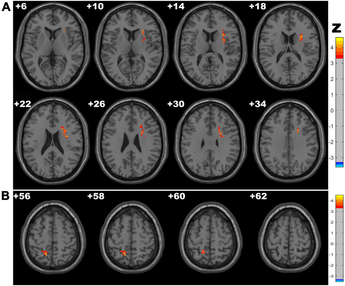 Frontiers | Altered Spontaneous Brain Activity Related to Neurologic ...
