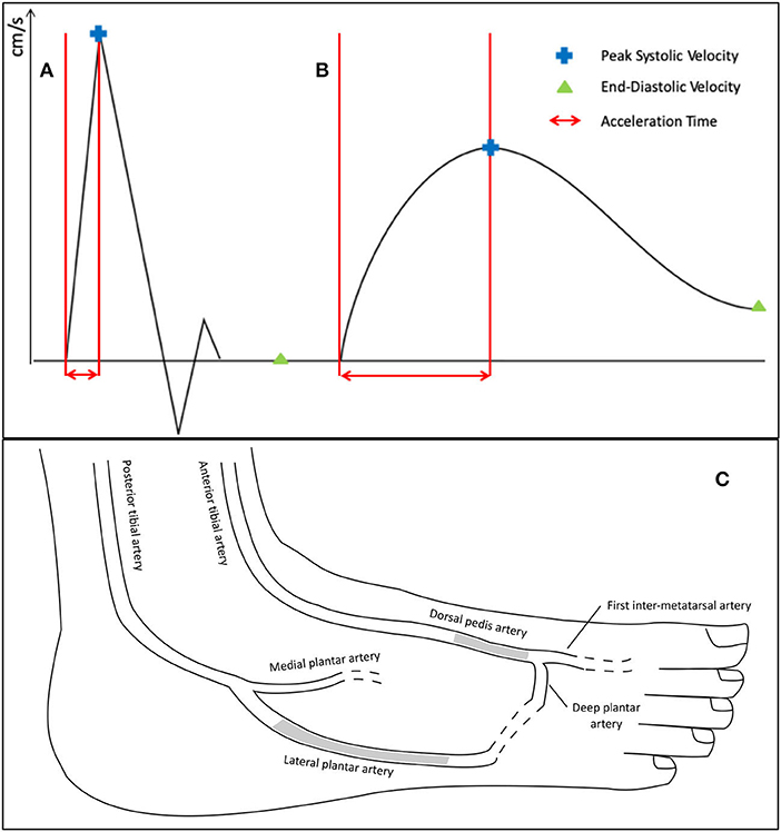 Frontiers | Accuracy of Acceleration Time of Distal Arteries to ...