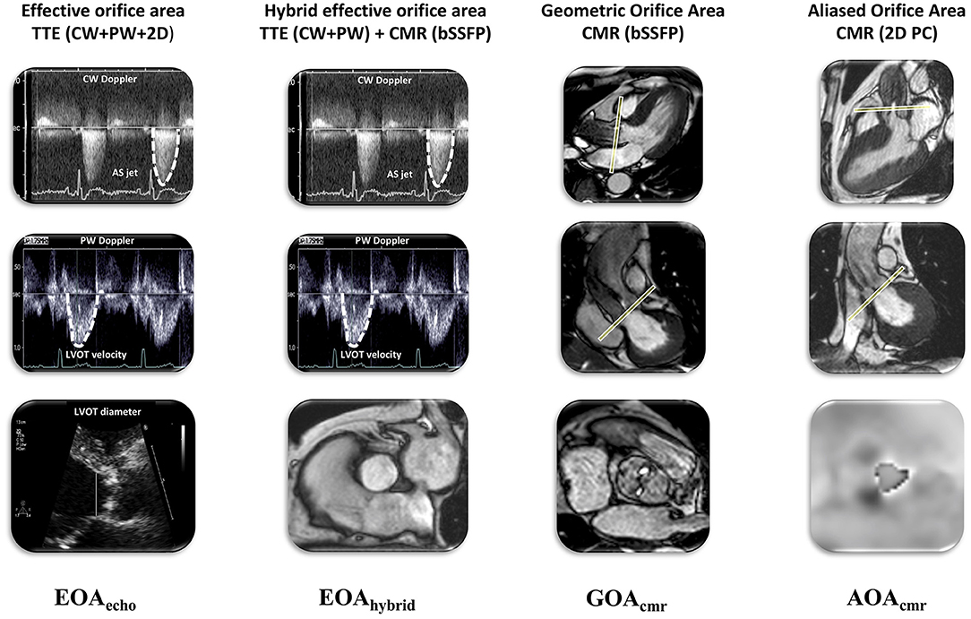 Frontiers | Aliased Flow Signal Planimetry by Cardiovascular Magnetic ...