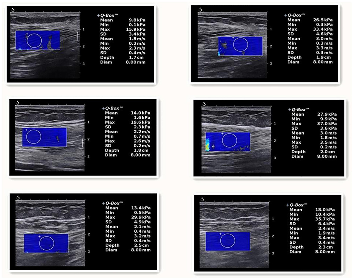 Frontiers | In Hamstring Muscles of Patients With Knee Osteoarthritis ...