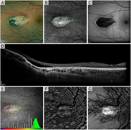 Frontiers | Multimodal Imaging of Torpedo Maculopathy With Fluorescence ...