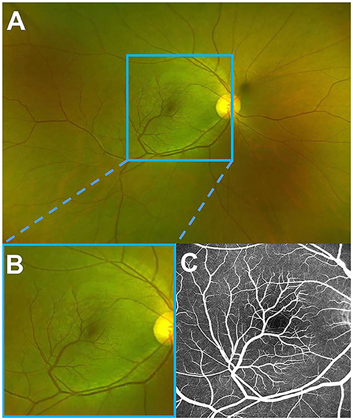 Frontiers | Case Report: Self-Resolved Macular Edema Secondary to ...