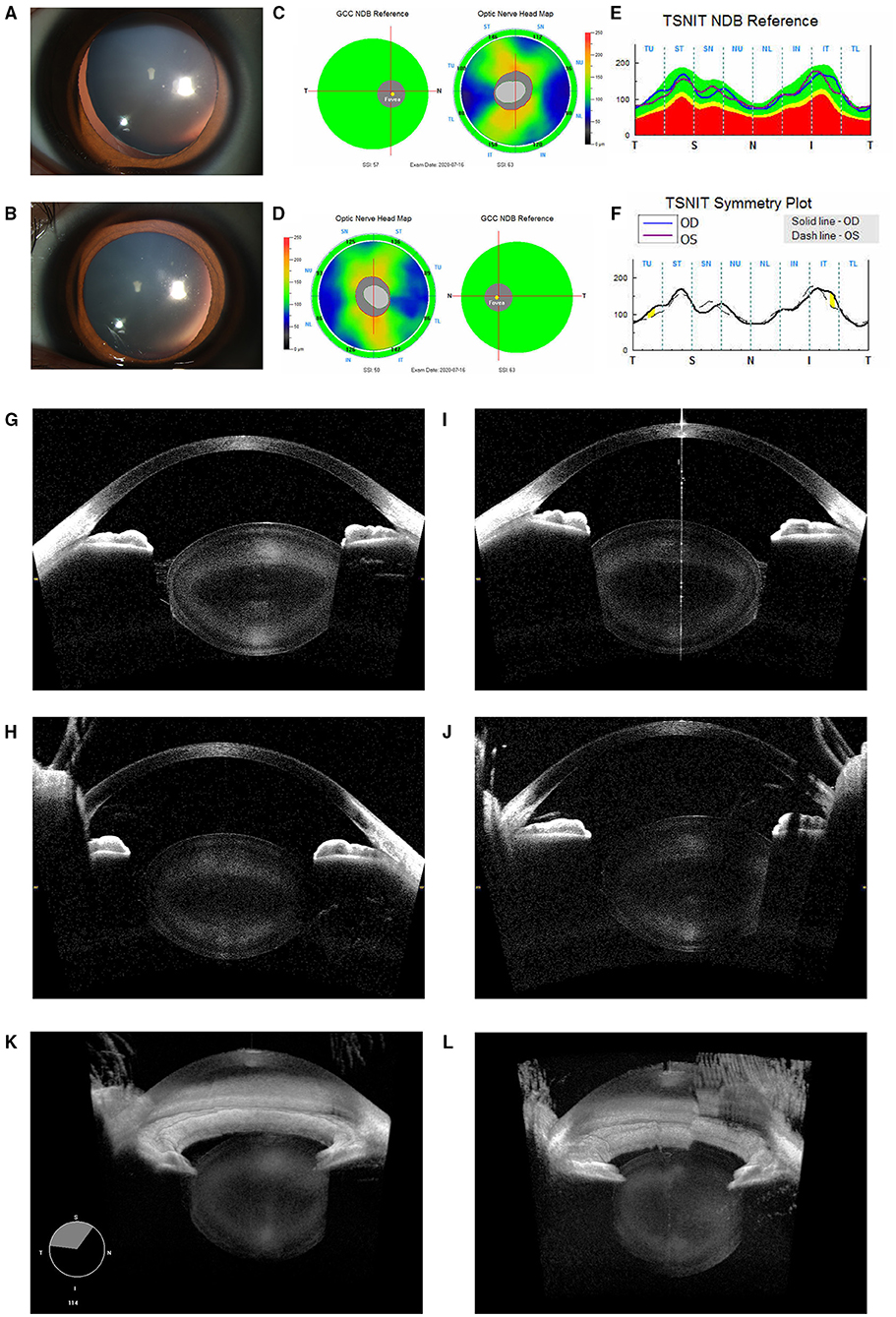 Frontiers | Lens Biometry in Congenital Lens Deformities: A Swept ...