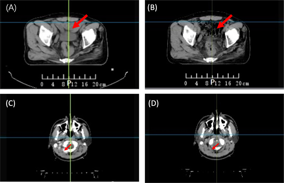 Frontiers | Evaluation of Daily CT for EPID-Based Transit In Vivo Dosimetry