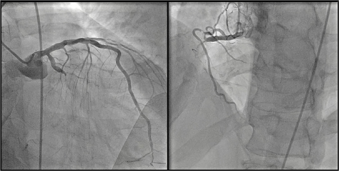 Frontiers | Case Report: Key Role of the Impella Device to Achieve ...