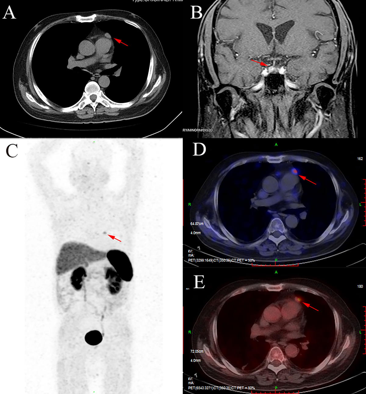 Frontiers | Case Report: An Unusual Case of Ectopic ACTH Syndrome ...