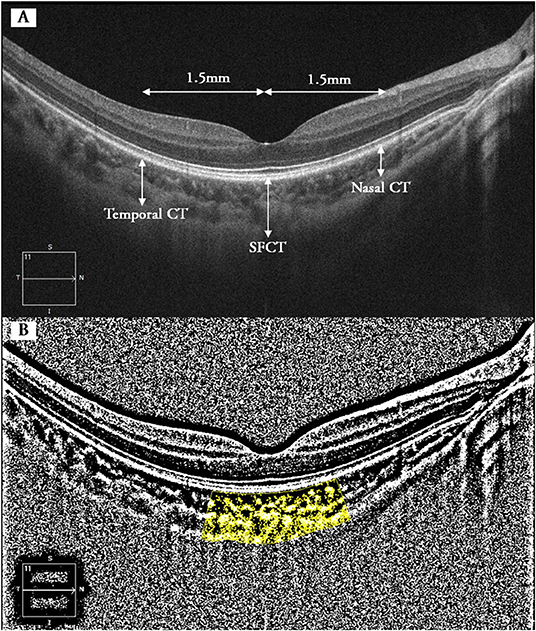 Frontiers | Choroidal Morphologic and Vascular Features in Patients ...
