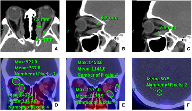 Frontiers | Monitoring and Predicting Treatment Response of Extraocular ...