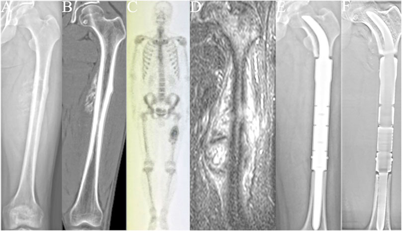 Frontiers | Hip-Preserved Reconstruction Using a Customized Cementless ...