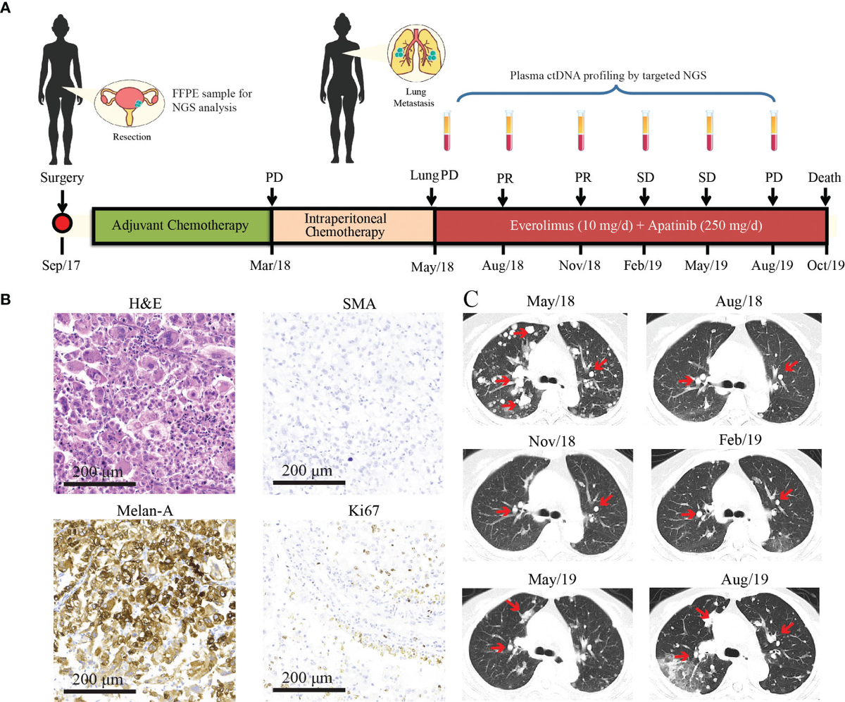 Frontiers | Uterine perivascular epithelioid tumors (PEComas) with lung ...