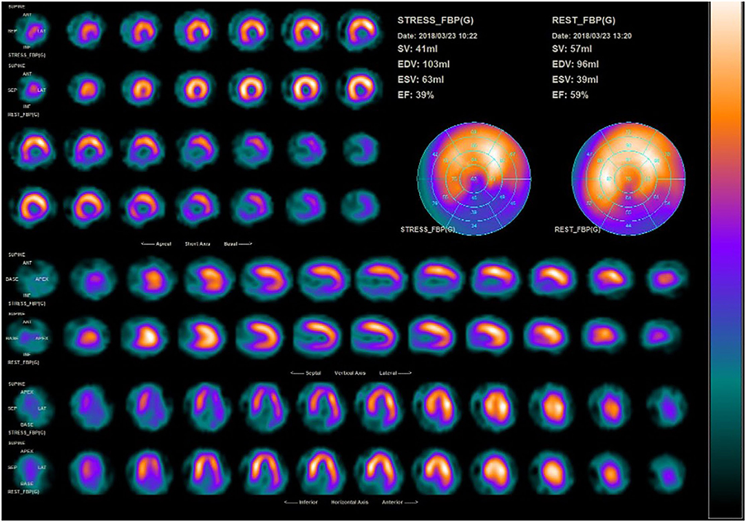 Frontiers | Case Series: Extracorporeal Shockwave Myocardial ...