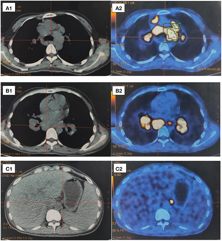 Frontiers | Multisystemic Sarcoidosis Presenting With Leg Ulcers ...