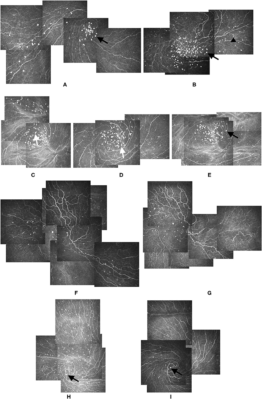 Frontiers | Analysis of Globular Cells in Corneal Nerve Vortex