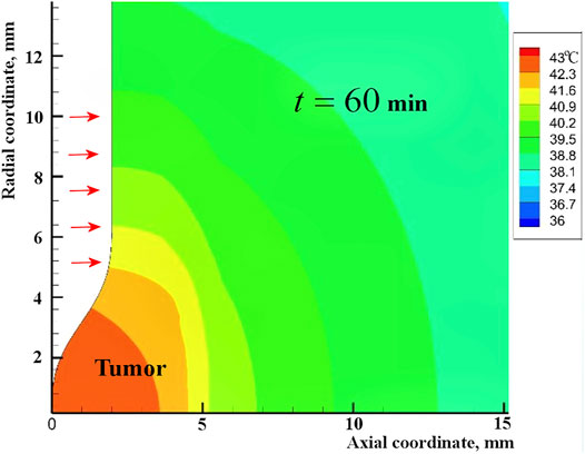Frontiers | Laser-Induced Thermal Treatment of Superficial Human Tumors ...