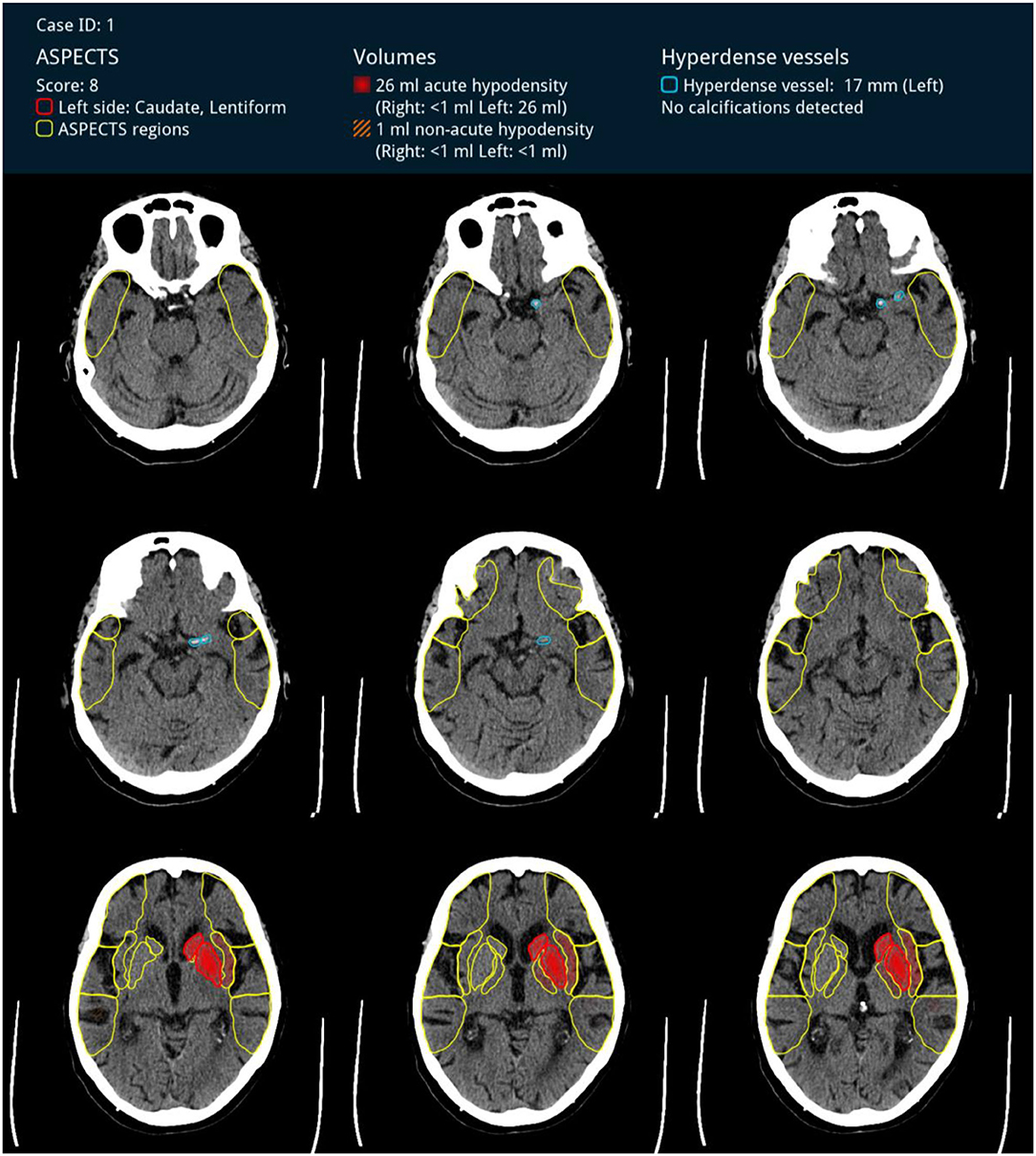 Frontiers | Hyperdense Artery Sign in Patients With Acute Ischemic ...