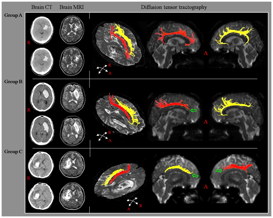 Frontiers | Injury of the cingulum in patients with putaminal ...