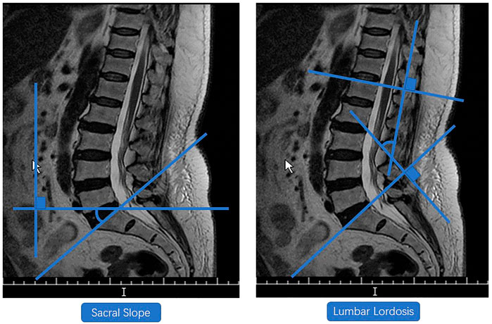 Frontiers | Asymmetric Biomechanical Properties of the Paravertebral ...