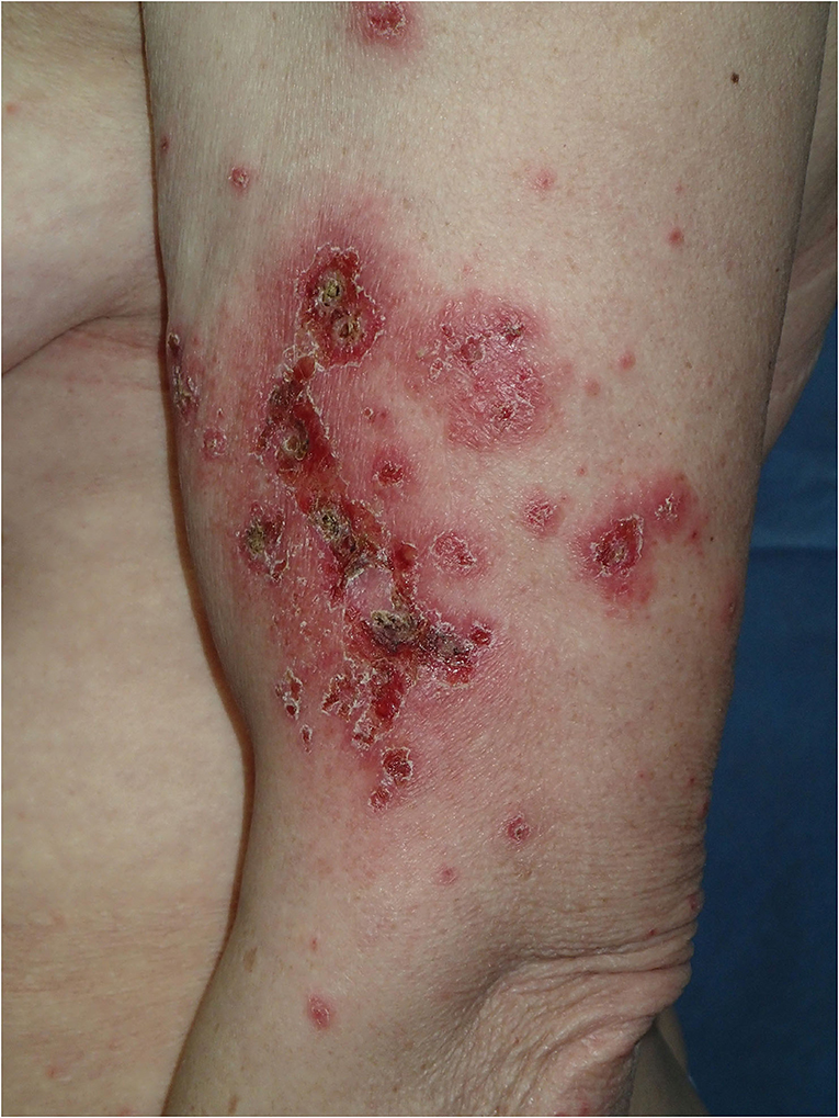 Frontiers | Case Report: Rowell Syndrome–Like Flare of Cutaneous Lupus ...