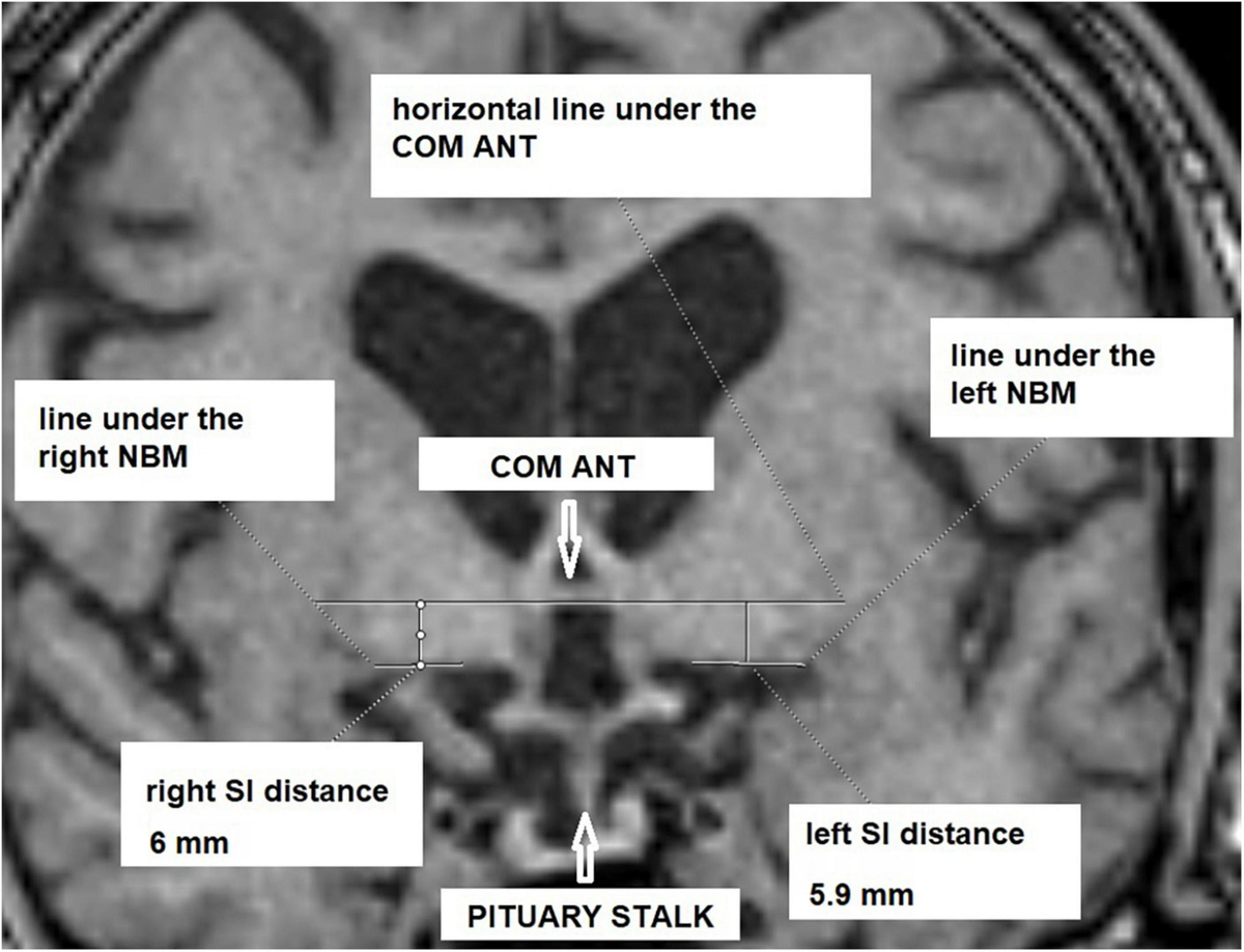 Frontiers | Metric magnetic resonance imaging analysis reveals ...