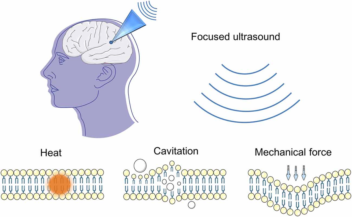 Frontiers | Review of Noninvasive or Minimally Invasive Deep Brain ...