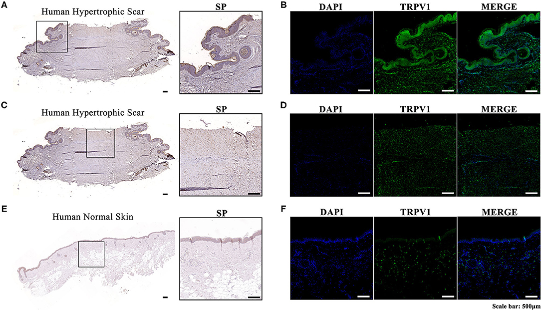Frontiers Dramatic Effect Of Botulinum Toxin Type A On Hypertrophic