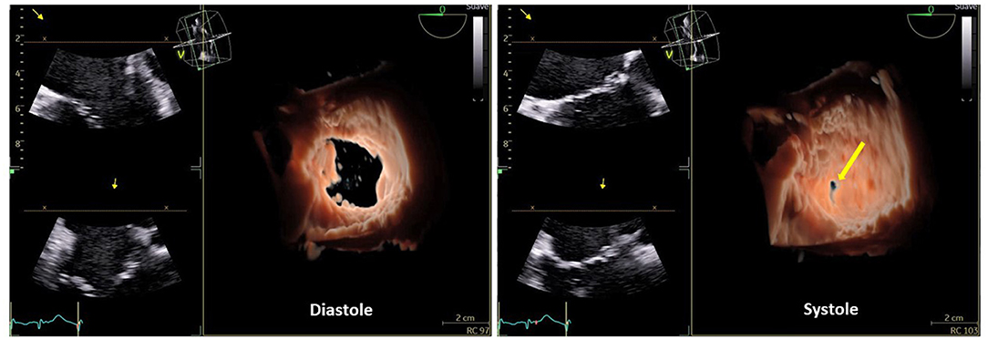 Frontiers | Functional Tricuspid Regurgitation: Behind the Scenes of a ...