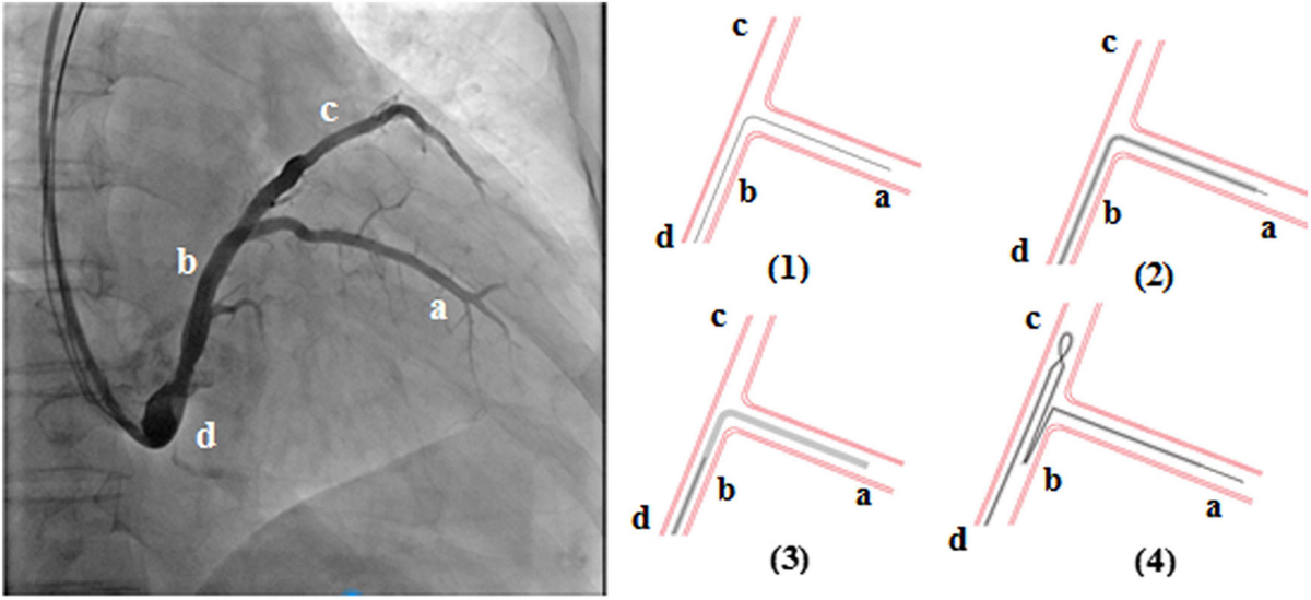 Frontiers | A Novel Approach for Repetitive Dislocation of Transvenous ...