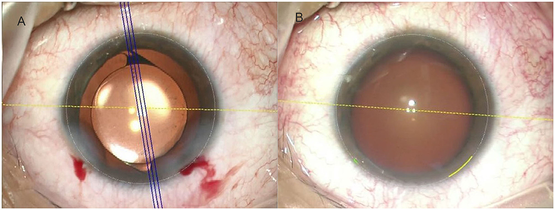 Frontiers | Comparison of Visual Outcomes Between Toric Intraocular Lenses and Clear Corneal ...