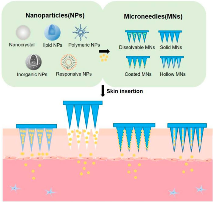 Frontiers | Microneedle-Mediated Transdermal Delivery of Drug-Carrying ...
