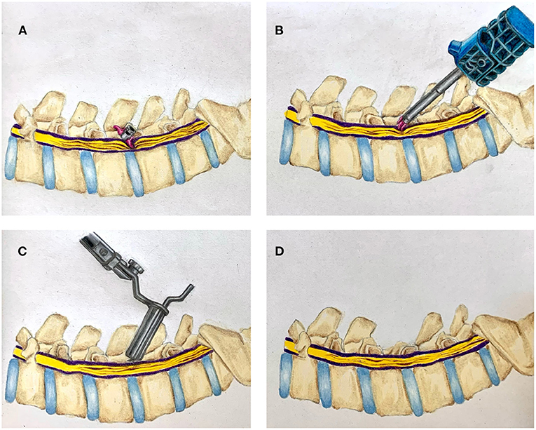 Frontiers | Neurosurgical Management of Interspinous Device ...