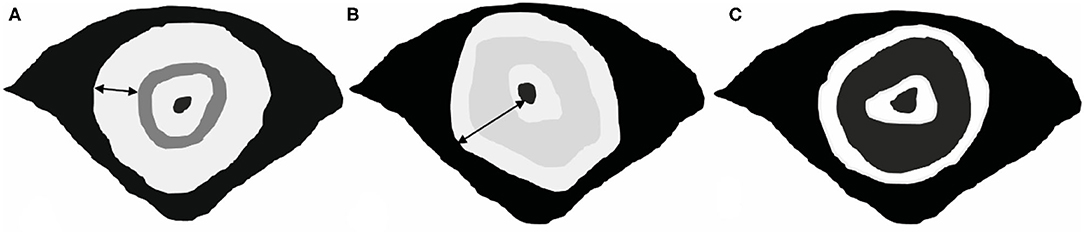 Frontiers | Rectal Signet Ring Cell Carcinoma: Post-Chemoradiotherapy ...