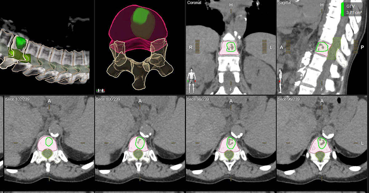 Frontiers | Clinical Evaluation of an Auto-Segmentation Tool for Spine ...