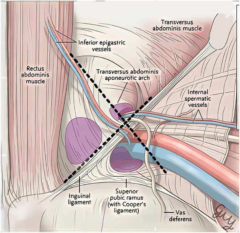 Frontiers | The Myopectineal Orifice: A Study of Thai Cadavers