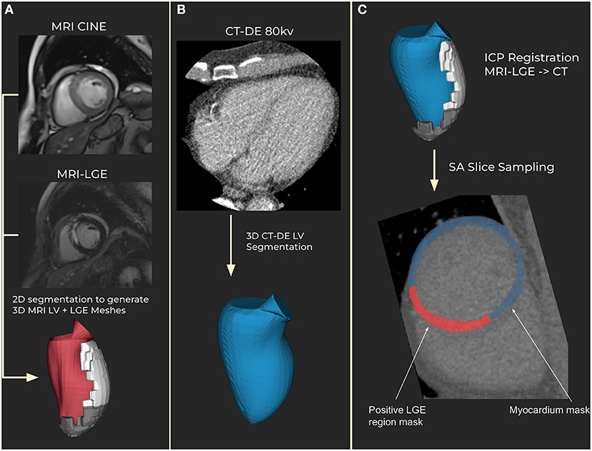 Frontiers | Radiomics and Machine Learning for Detecting Scar Tissue on ...