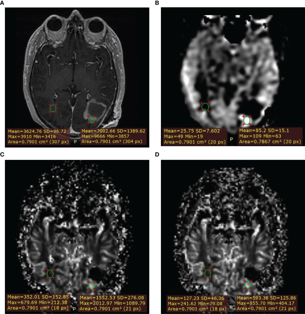 Frontiers | Diagnostic Accuracy of Arterial Spin Labeling in Comparison ...
