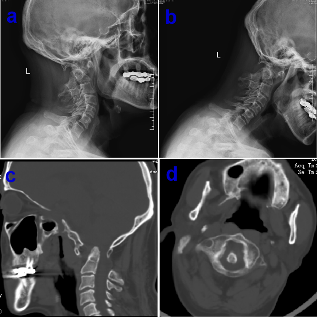 Frontiers | Precise Management of Chiari Malformation with Type I