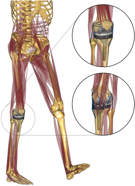 Frontiers | Biomechanical Effect of Coronal Alignment and Ligament ...