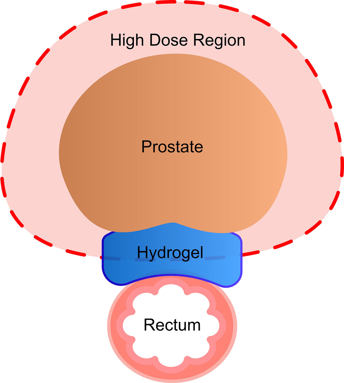 Frontiers | Rectal Radiation Dose and Clinical Outcomes in Prostate ...